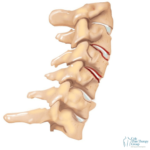 How to Manage Spondylosis: Causes, Symptoms & Treatment Options - Cole ...