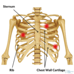 Costochondritis: Understanding Chest Wall Pain and How to Manage It ...