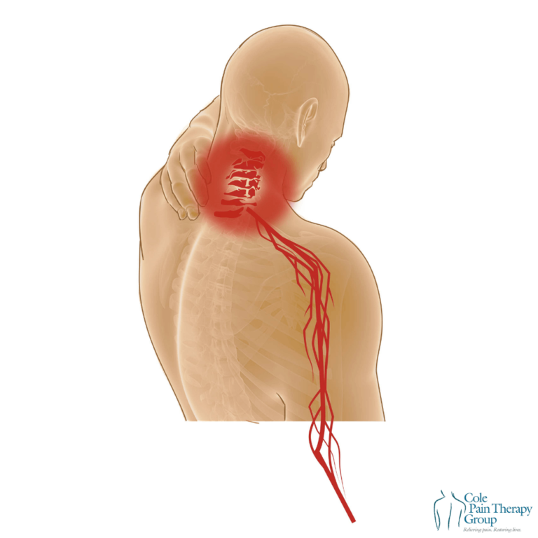Radiculopathy Relief: How to Treat Pain and Speed Up Recovery - Cole ...