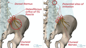How to Overcome Maigne Syndrome and Treat Cluneal Nerve Pain - Cole ...