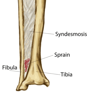 Syndesmotic Ankle Injury: What You Need To Know For A Faster Recovery ...
