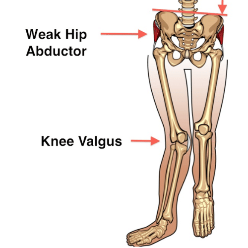 Everything You Need to Know About Hip Abductor Weakness and Its Impact ...