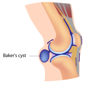 How to Relieve Baker’s Cyst Pain and Improve Knee Comfort - Cole Pain ...