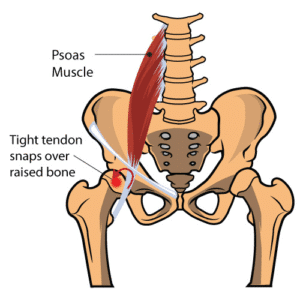 How to Overcome Psoas Tendinopathy and Relieve Hip Pain - Cole Pain ...
