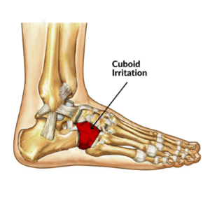 How To Overcome Cuboid Syndrome and Relieve Foot Pain - Cole Pain ...