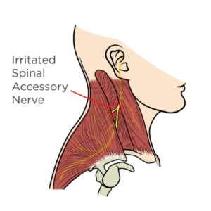 How to Overcome Spinal Accessory Neuropathy and Restore Shoulder ...