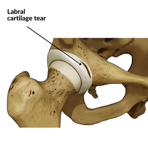 Hip Labral Lesion Treatment in Memphis, TN | Cole Pain Therapy Group