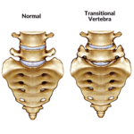 Lumbosacral Transitional Vertebra Pain Relief | Cole Pain Therapy Group