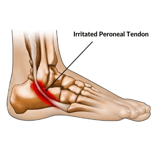 Peroneal Tendon Pain Treatment | Outer Ankle Pain Relief
