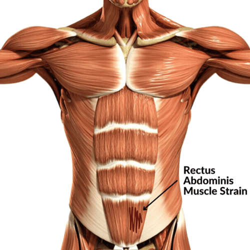Rectus Abdominis Strain Treatment | Cole Pain Therapy Group