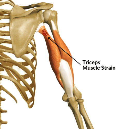 Triceps Muscle Strain Treatment | Cole Pain Therapy Group