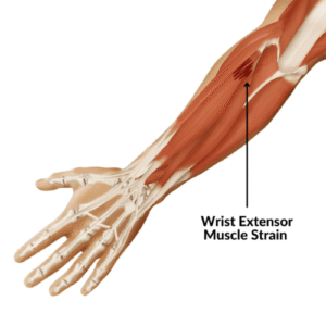 Wrist Extensor Pain Treatment | Cole Pain Therapy Group