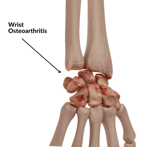 Wrist Osteoarthritis Treatment | Cole Pain Therapy Group