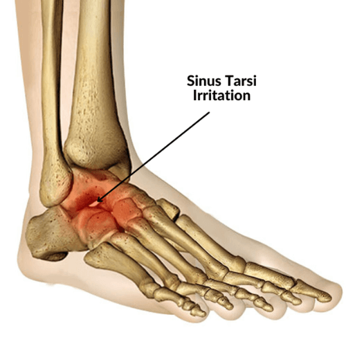 Focused Shockwave Therapy for Sinus Tarsi Syndrome | Cole Pain Therapy ...